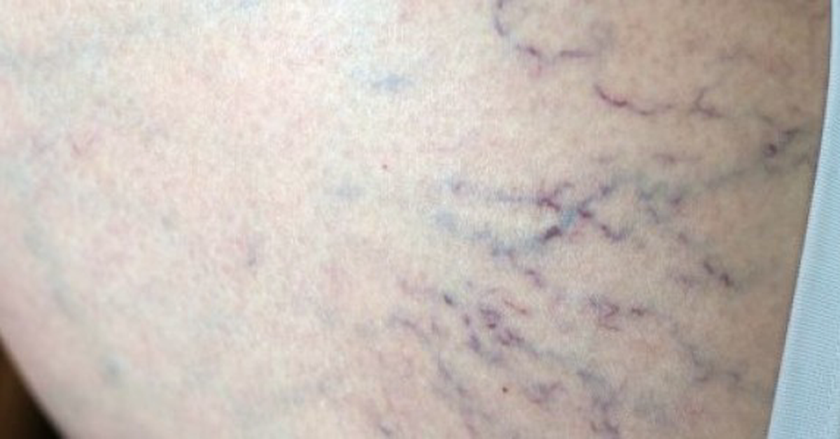 Yuk Kenali Apa itu Varises!